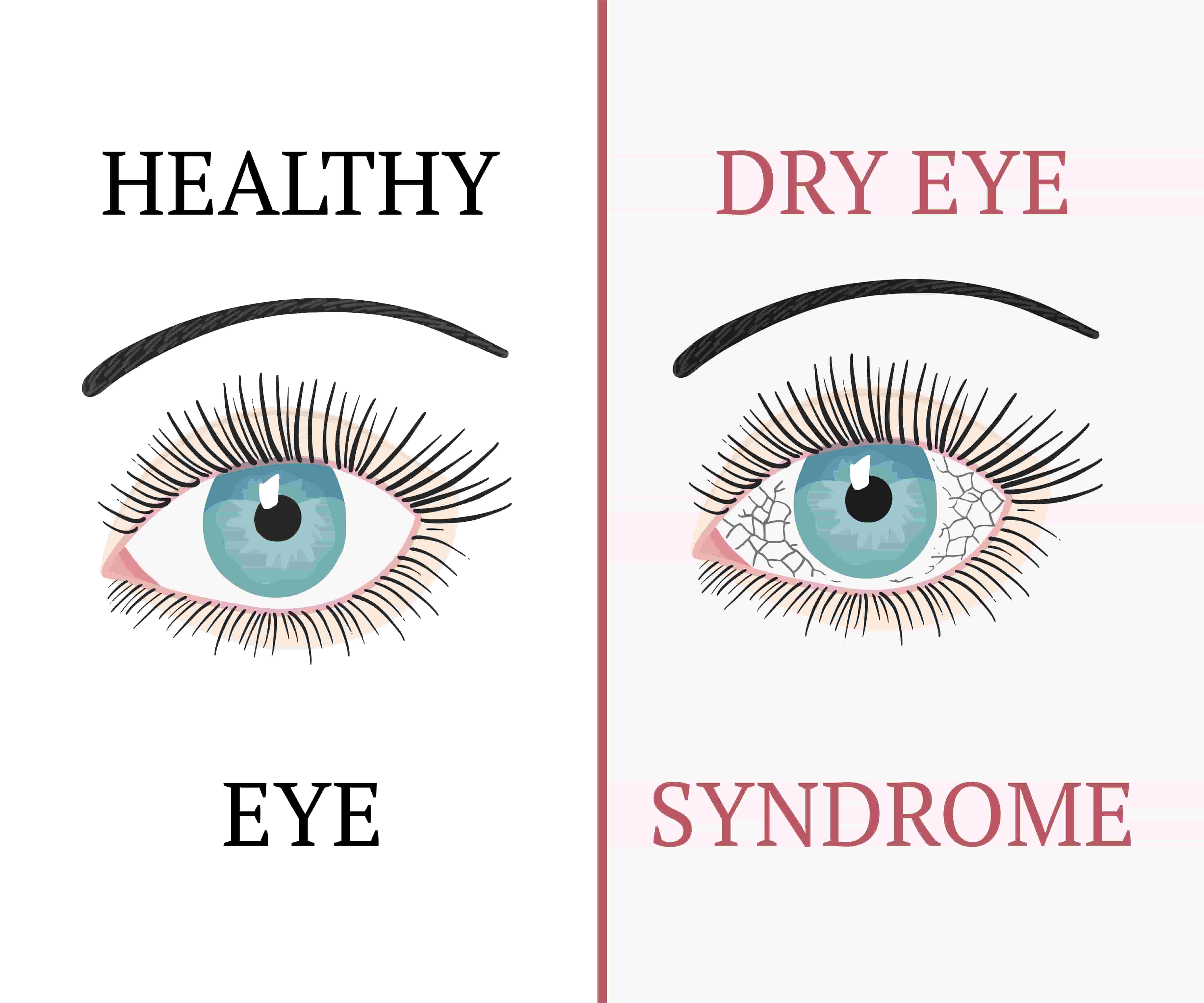 Dry Eye Syndrome Treatment in Chicago, IL | Kraff Eye Institute